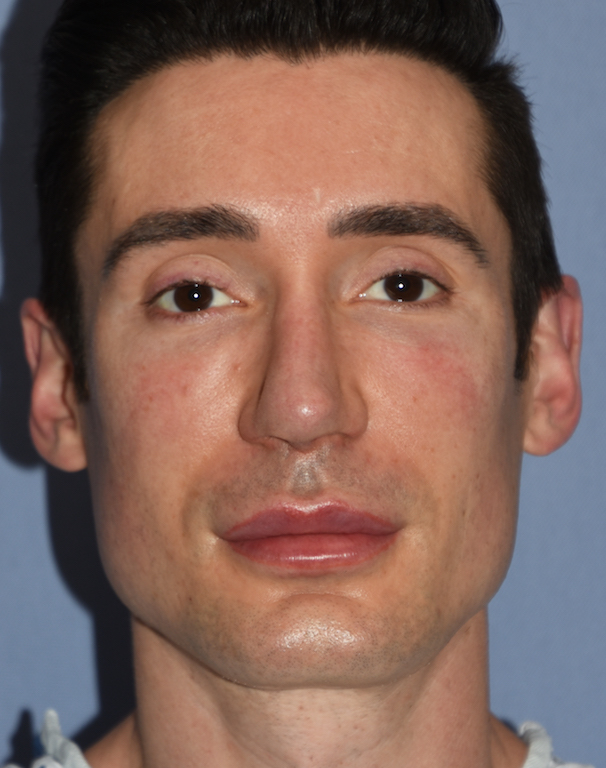 Plastic Surgery Case Study - Custom Infraorbital-Malar Implants for the ...