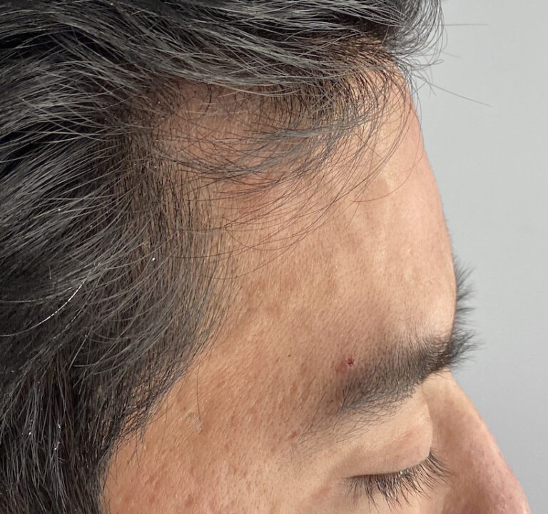 Plastic Surgery Case Study - Upper Facial Masculinization with a Custom ...