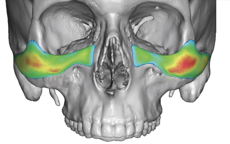 Plastic Surgery Case Study - Custom Infraorbital-Malar Implants for the ...