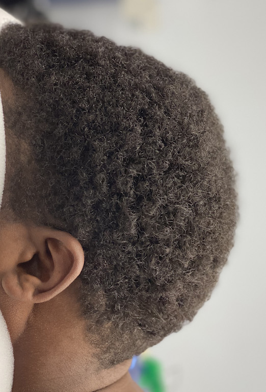 Plastic Surgery Case Study - Occipital Skull Reduction Using A Quadrant ...