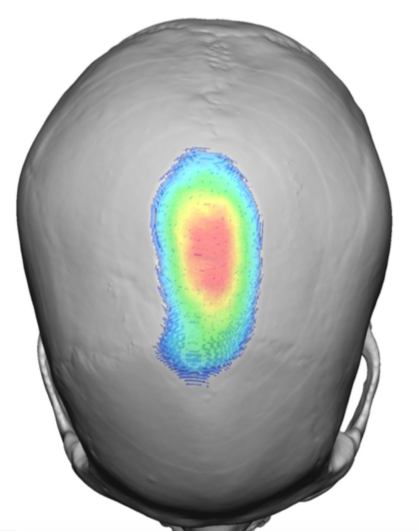 Plastic Surgery Case Study - Correction of the Peaked Head Shape By A ...