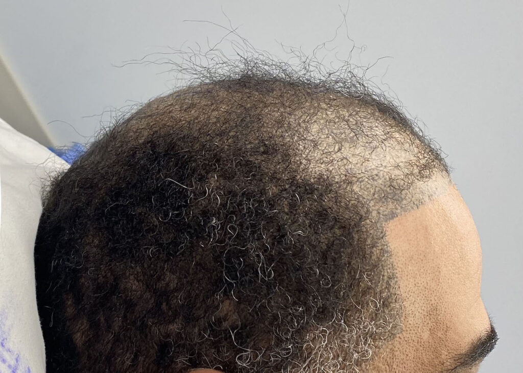 Plastic Surgery Case Study - Correction of the Peaked Head Shape By A ...