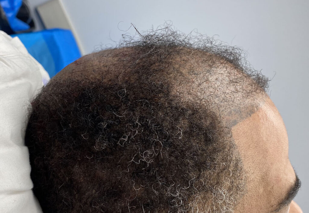 Plastic Surgery Case Study - Correction of the Peaked Head Shape By A ...