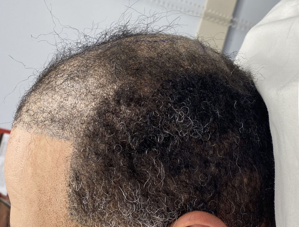 peaked head shape skull reshaping side before De Barry Eppley ...