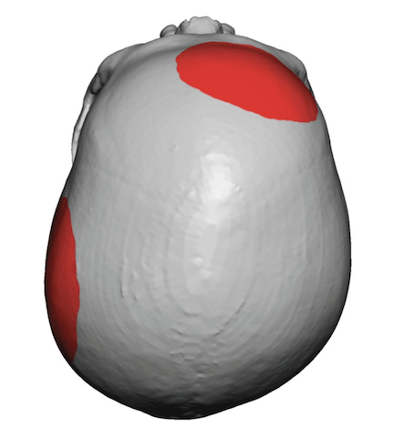 right forehead and left temporal reduction plan top view Dr Barry ...
