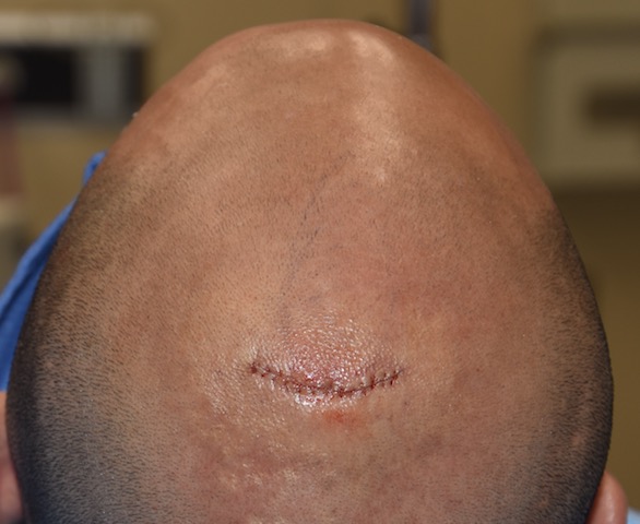 Plastic Surgery Case Study - Sagittal Ridge Skull Reduction in the ...