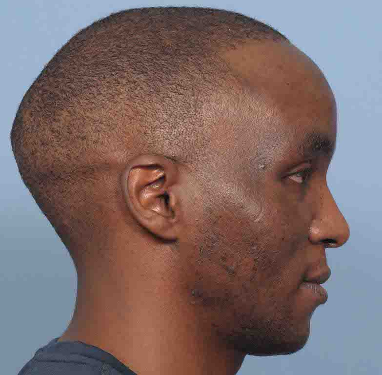 Plastic Surgery Case Study - Adult Scaphocephalic Total Head Reshaping ...