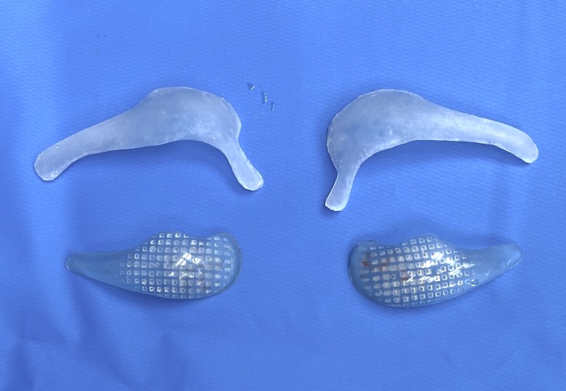 Plastic Surgery Case Study - Replacement of Standard Cheek Implants ...