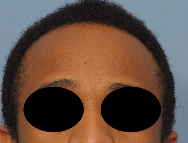 Plastic Surgery Case Study - Male Temporal Reduction Surgery for Wide ...