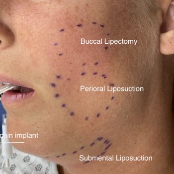 facial reshaping Archives - Explore Plastic Surgery