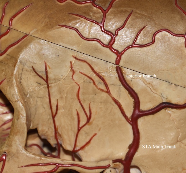 The Mid Forehead Ligation Point In Temporal Artery Ligation For