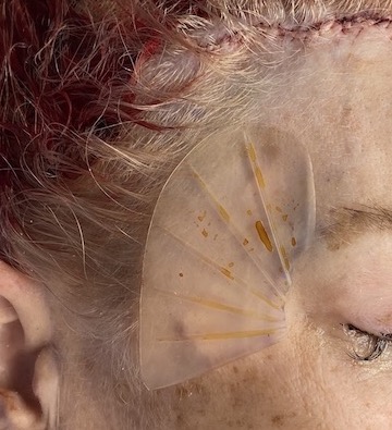 Technical Strategies - Placement of Extended Temporal Implants Through ...