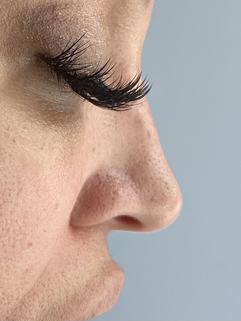 female premaxillary implant intraop rigth side 1 Dr Barry Eppley ...