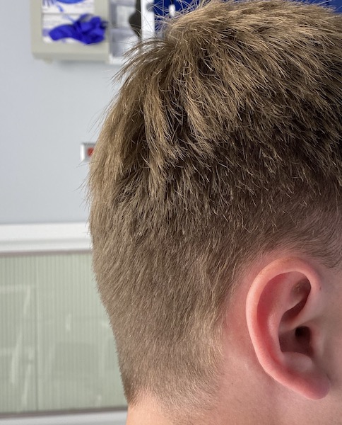 Plastic Surgery Case Study - Custom Skull Implant for Flat Back of Head ...