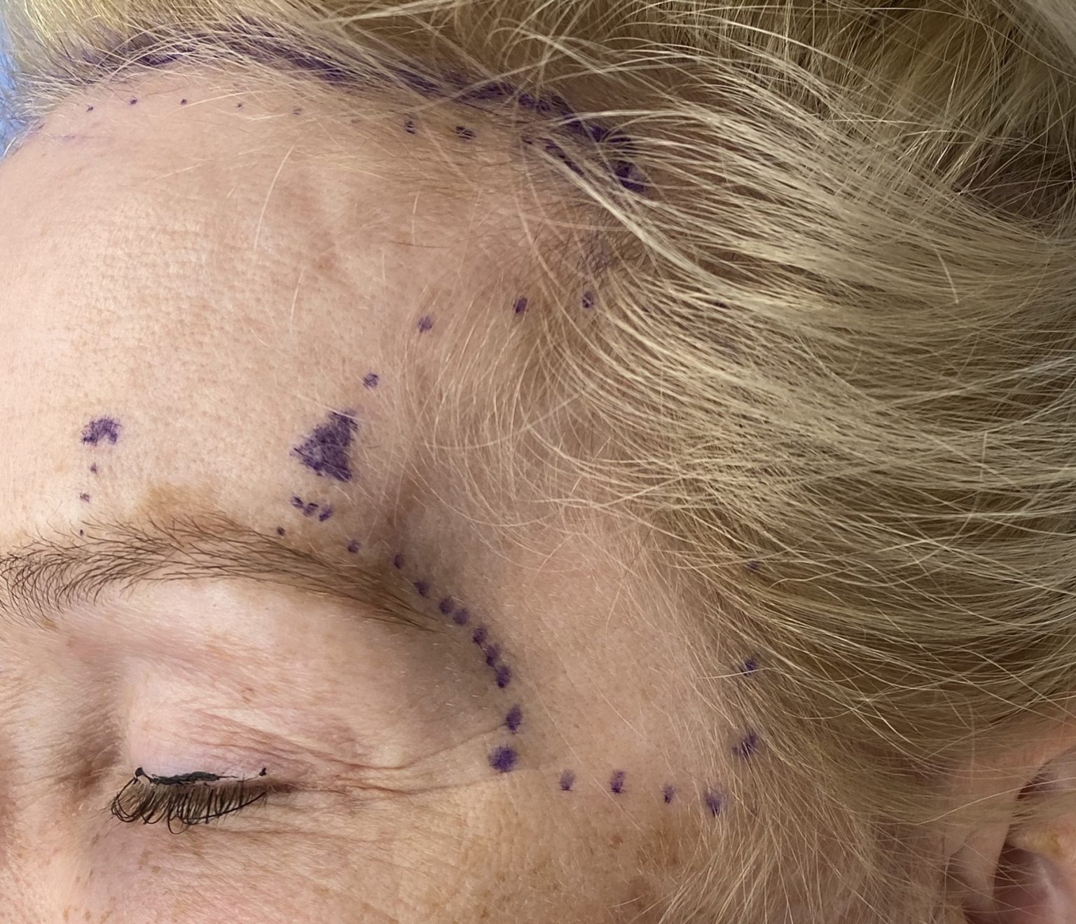 Technical Strategies - Placement of Extended Temporal Implants Through ...