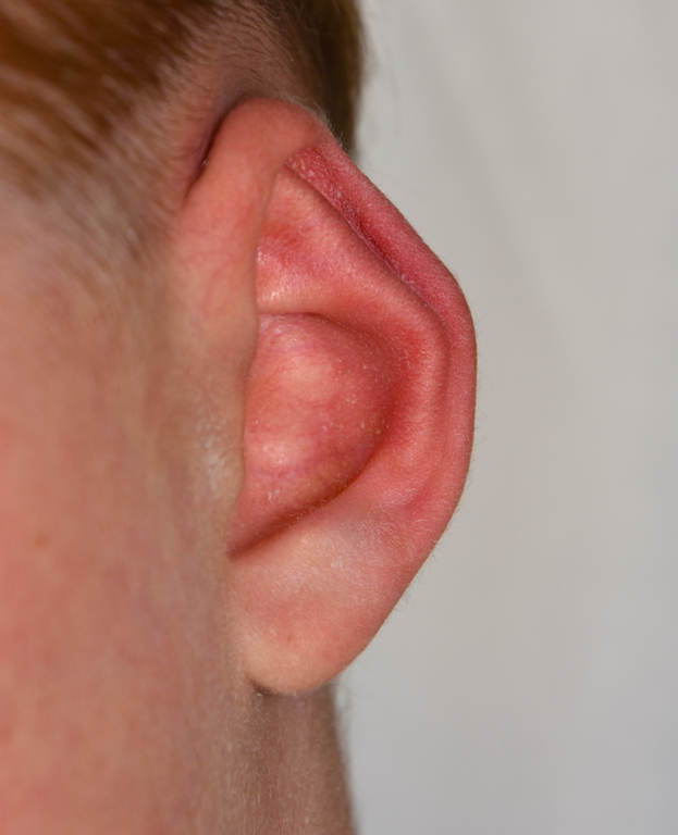 Plastic Surgery Case Study - Secondary Correction of the Incisionless ...