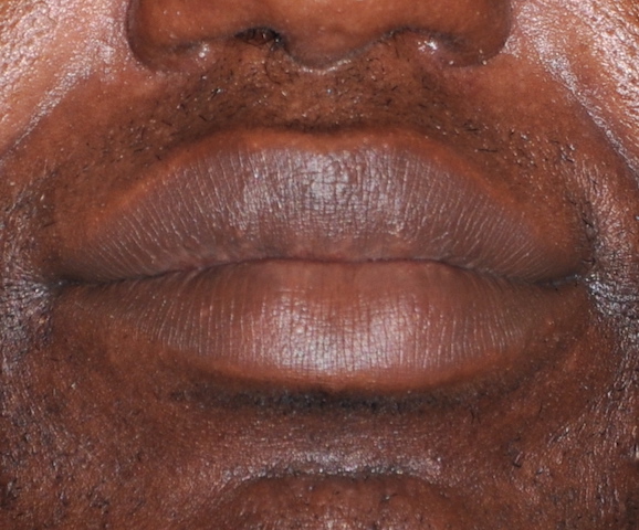 Plastic Surgery Case Study - Secondary Lip Reductions with Indwelling ...