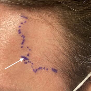 temporal artery ligation Archives - Explore Plastic Surgery