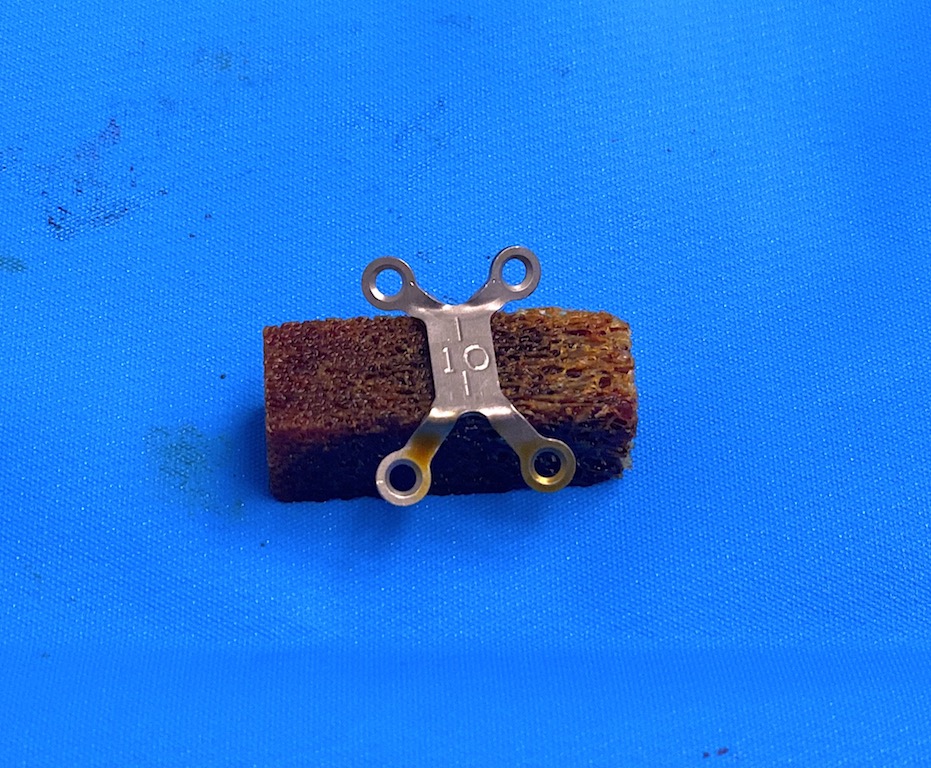 vertical chin lengthening plate and bone block Dr Barry Eppley ...