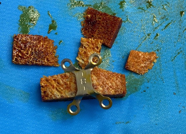 vertical lengthening genioplasty playe with interpositional bone graft ...