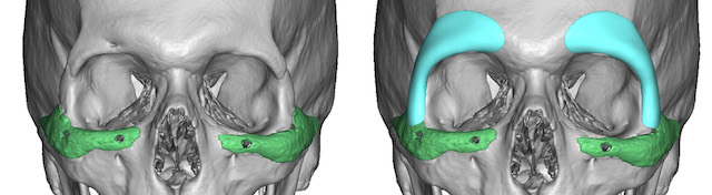 Injectable Augmentation of the Lateral Orbital Rim Area for Enhanced ...