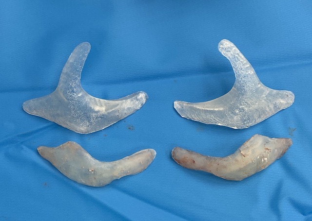 Plastic Surgery Case Study - The Custom Infralateral Orbital Rim-Malar ...