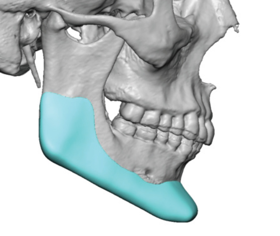 Male Custom Jawline Implantys designs side view Dr Barry Eppley ...
