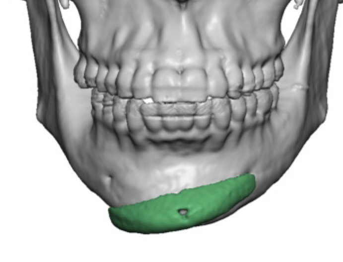 chin implant asymmetry front view 3D CT scan Dr Barry Eppley ...