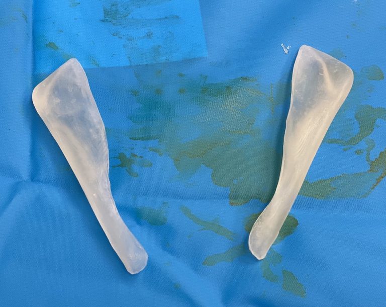 Plastic Surgery Case Study - Vertical Lengthening Sliding Genioplasty ...