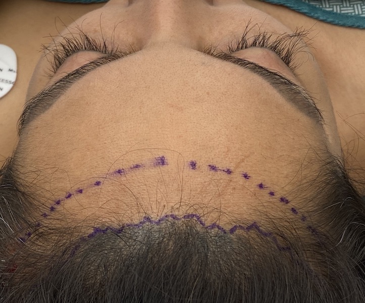 Plastic Surgery Case Study - Frontal Hairline Advancement in the Bell ...