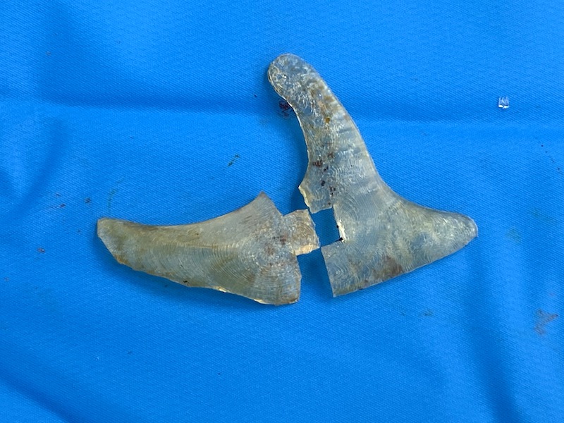 Plastic Surgery Case Study - The Custom Infralateral Orbital Rim-Malar ...