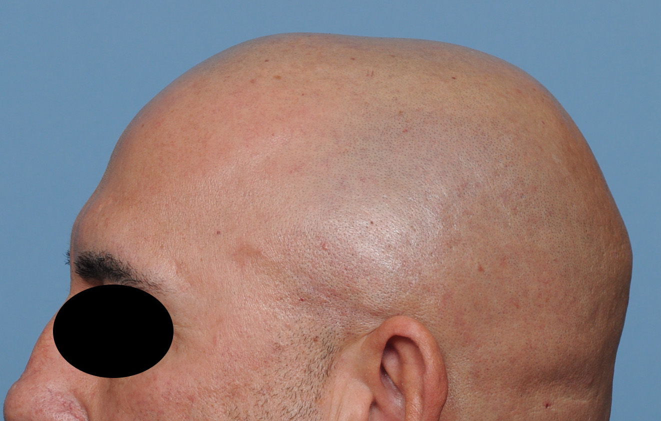 Plastic Surgery Case Study - Multilevel Skull Augmentation with Custom ...