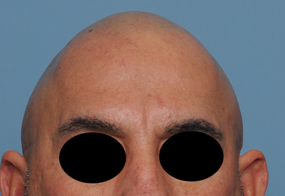 Plastic Surgery Case Study - Multilevel Skull Augmentation with Custom ...