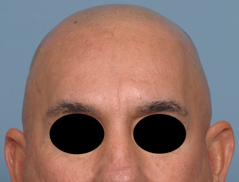 male custom supraorbital and skull implants front 2 Dr Barry Eppley ...