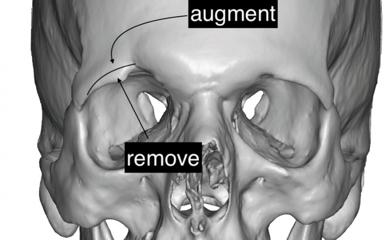 Plastic Surgery Case Study - Secondary Tail of the Brow Bone ...