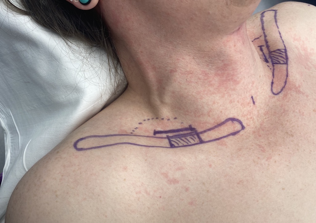 shoulder narrowing markings oblique 1 Dr Barry Eppley Indianapolis ...