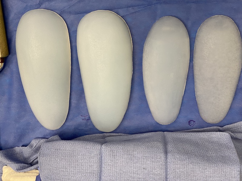 Plastic Surgery Case Study - Total Aesthetic Leg Augmentation with ...