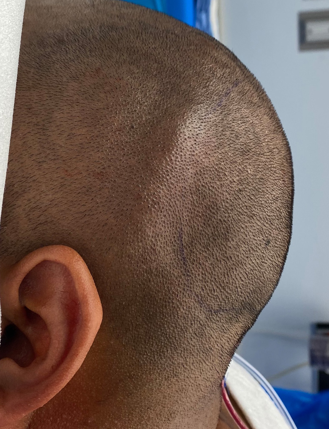 Plastic Surgery Case Study - Skull Reshaping with Custom Skull Implant ...