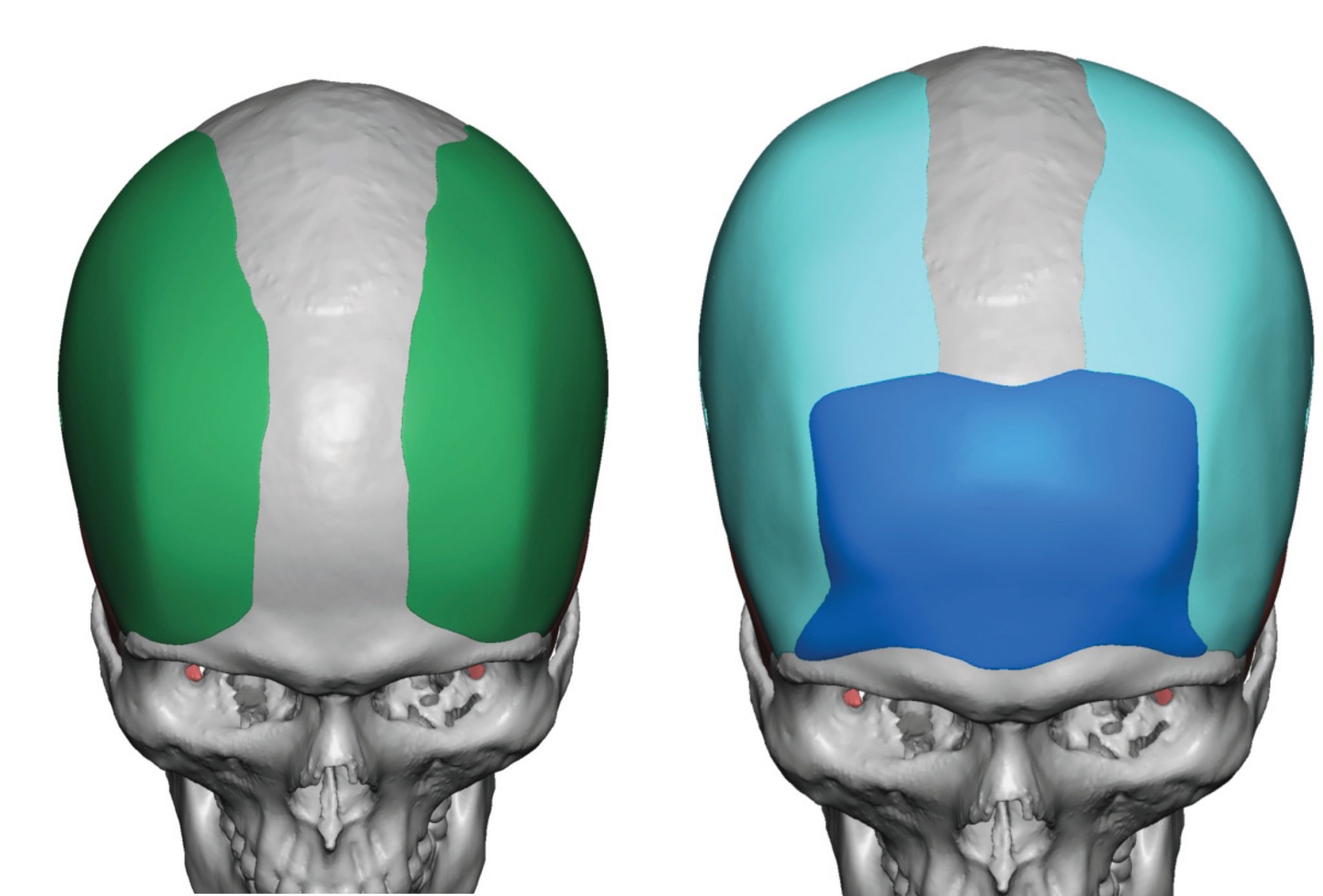 Evolution of Head Widening Front-Temporal Implant Designs - Explore ...