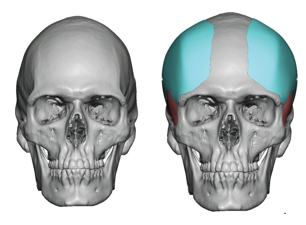 Evolution of Head Widening Front-Temporal Implant Designs - Explore ...