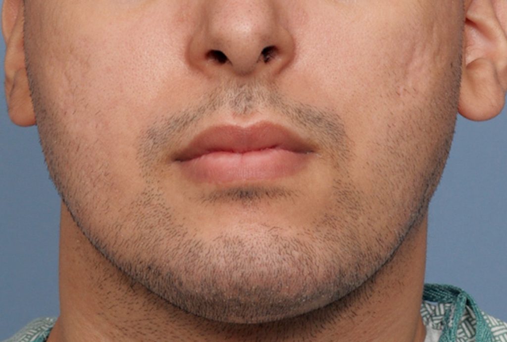 Plastic Surgery Case Study - Secondary Custom Jaw Angles Implants After ...