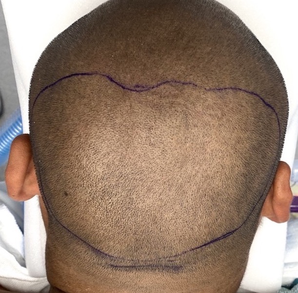 Plastic Surgery Case Study - Skull Reshaping with Custom Skull Implant ...