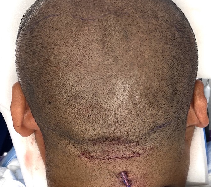 Plastic Surgery Case Study - Skull Reshaping with Custom Skull Implant ...