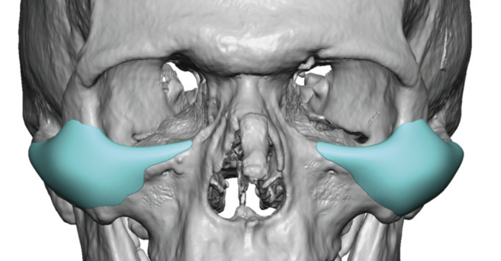 Custom Infraorbital-Malar Implants - Intraoral vs Lower Eyelid ...