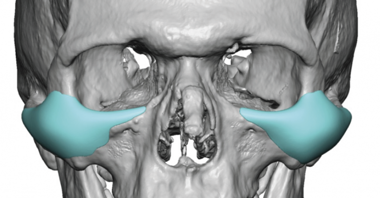 Custom Infraorbital-Malar Implants - Intraoral vs Lower Eyelid ...