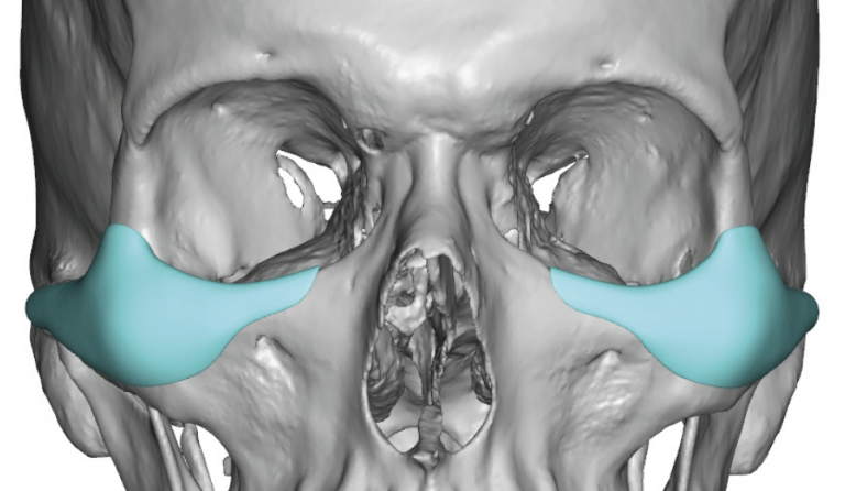 Technical Strategies - Infraorbital-Malar Implants and The Lower Eyelid ...
