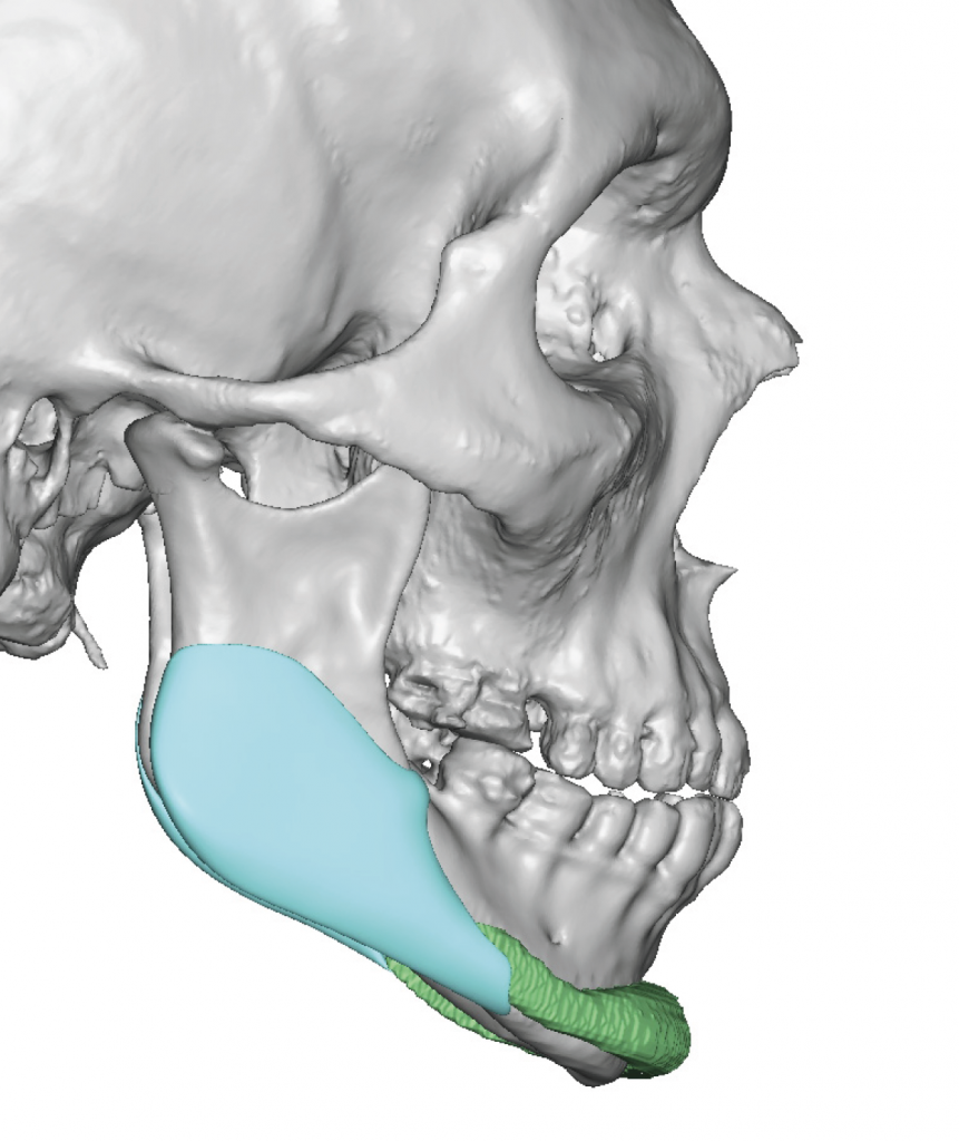 Plastic Surgery Case Study - Secondary Custom Jaw Angles Implants After ...