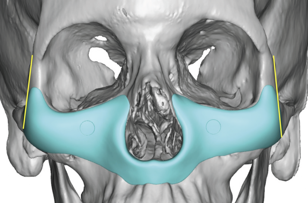 Design and Placement Concepts of Custom Midface Implants - Explore ...