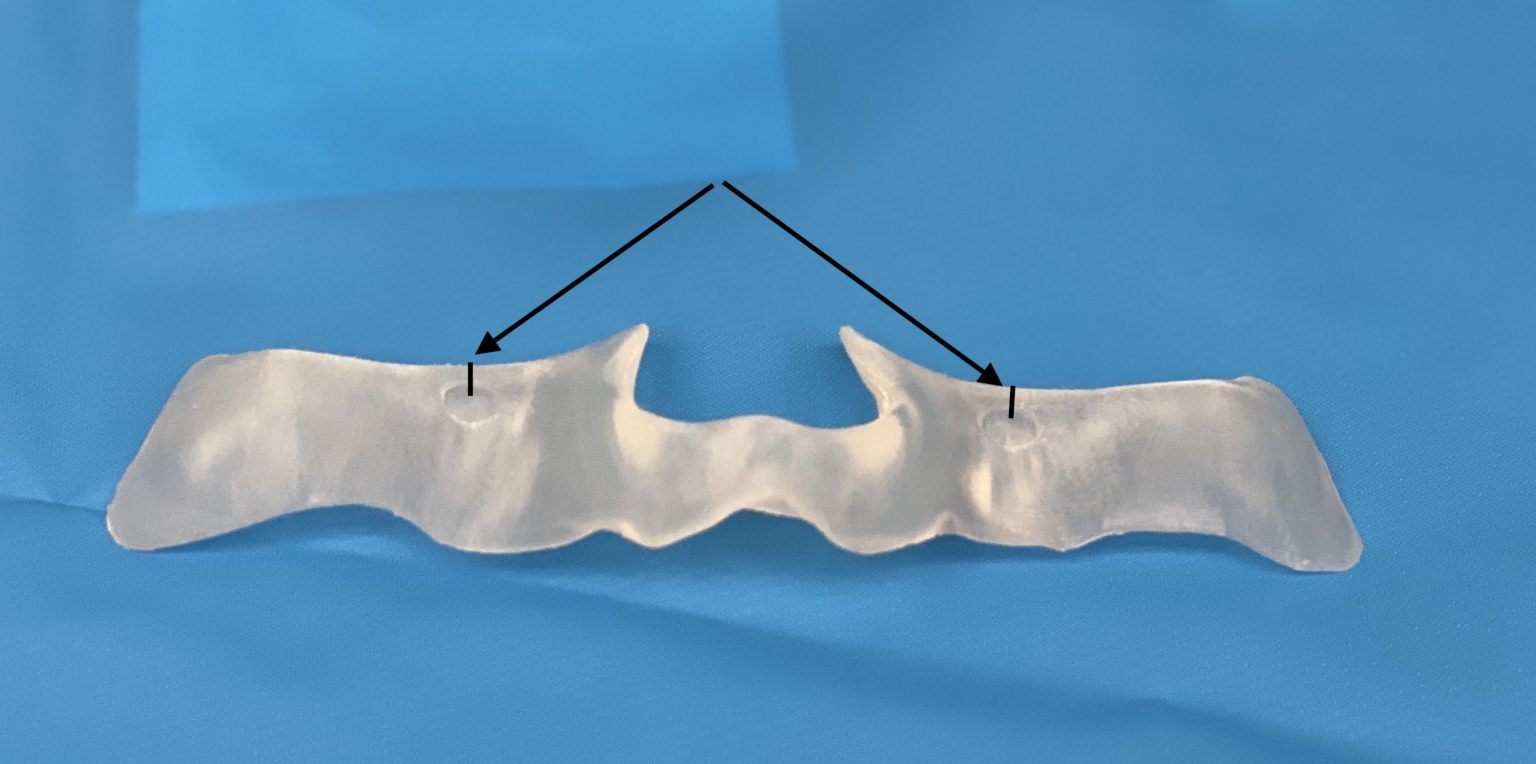 Design and Placement Concepts of Custom Midface Implants - Explore ...