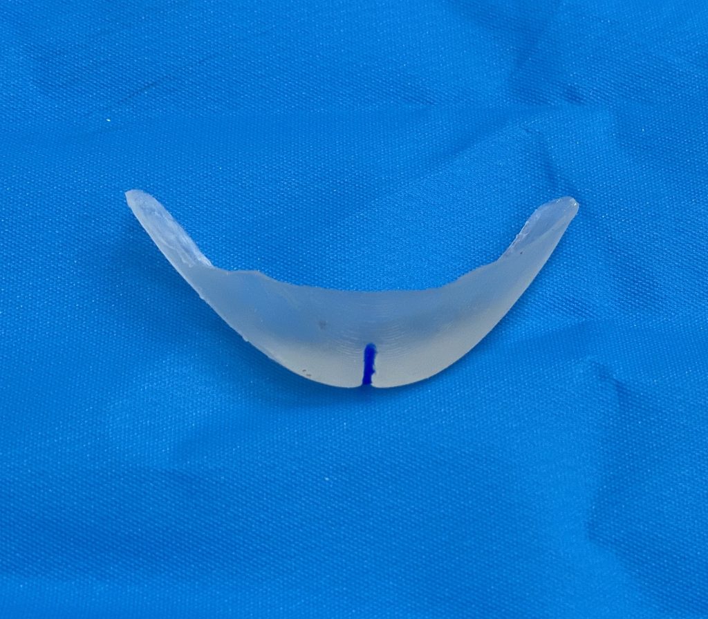 Plastic Surgery Case Study - Female Medpor Chin Implant Replacement ...